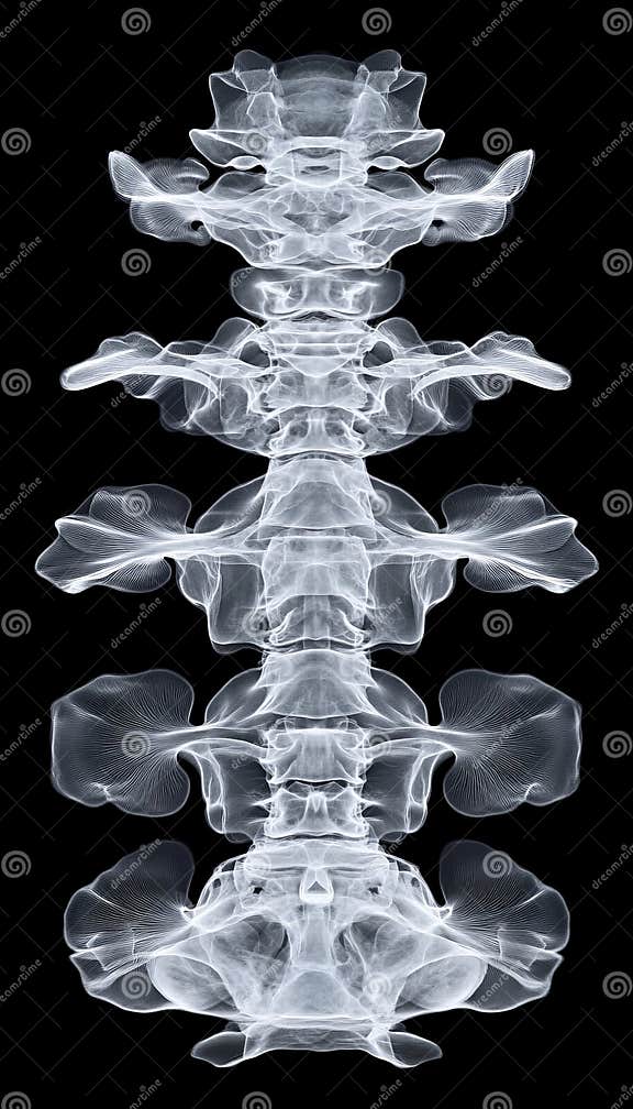 Severe Spinal Disc Degeneration X-ray Visualization of Bone Spurs and ...