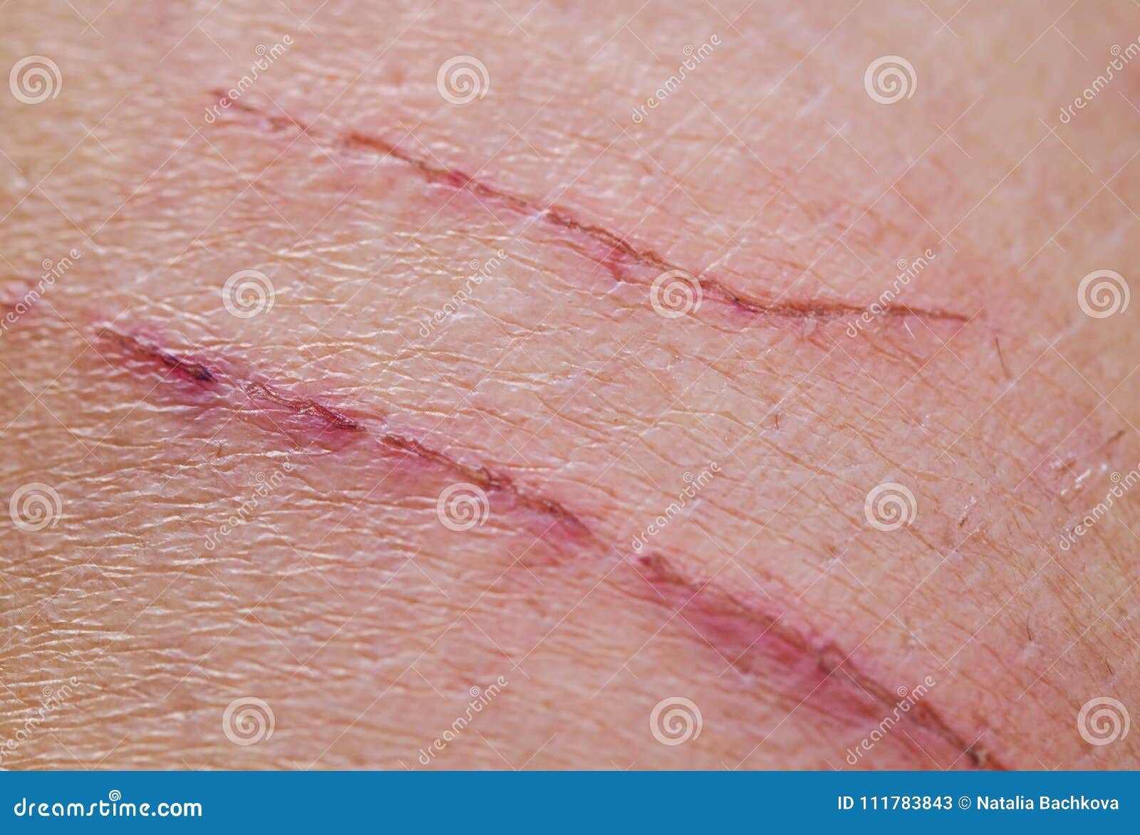 Shallow Inflamed Scratches on Human Skin Stock Image - Image of danger ...