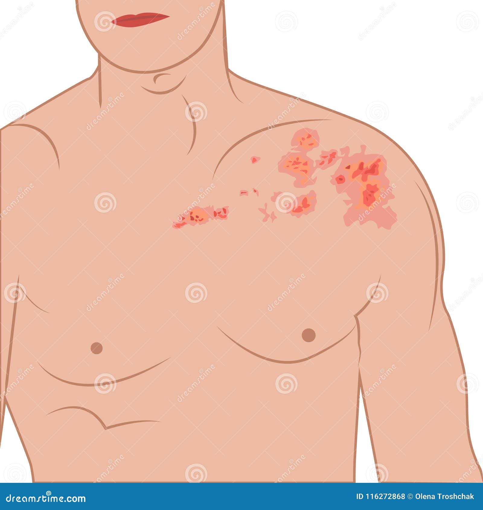 Shingles Symptoms - Viral Infection That Causes A Painful Rash, Medical ...