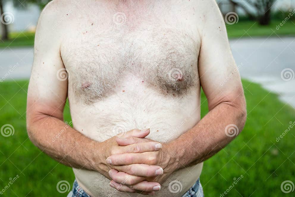 Shirtless Torso Of Caucasian Male With Sun Burned Arms Stock Image