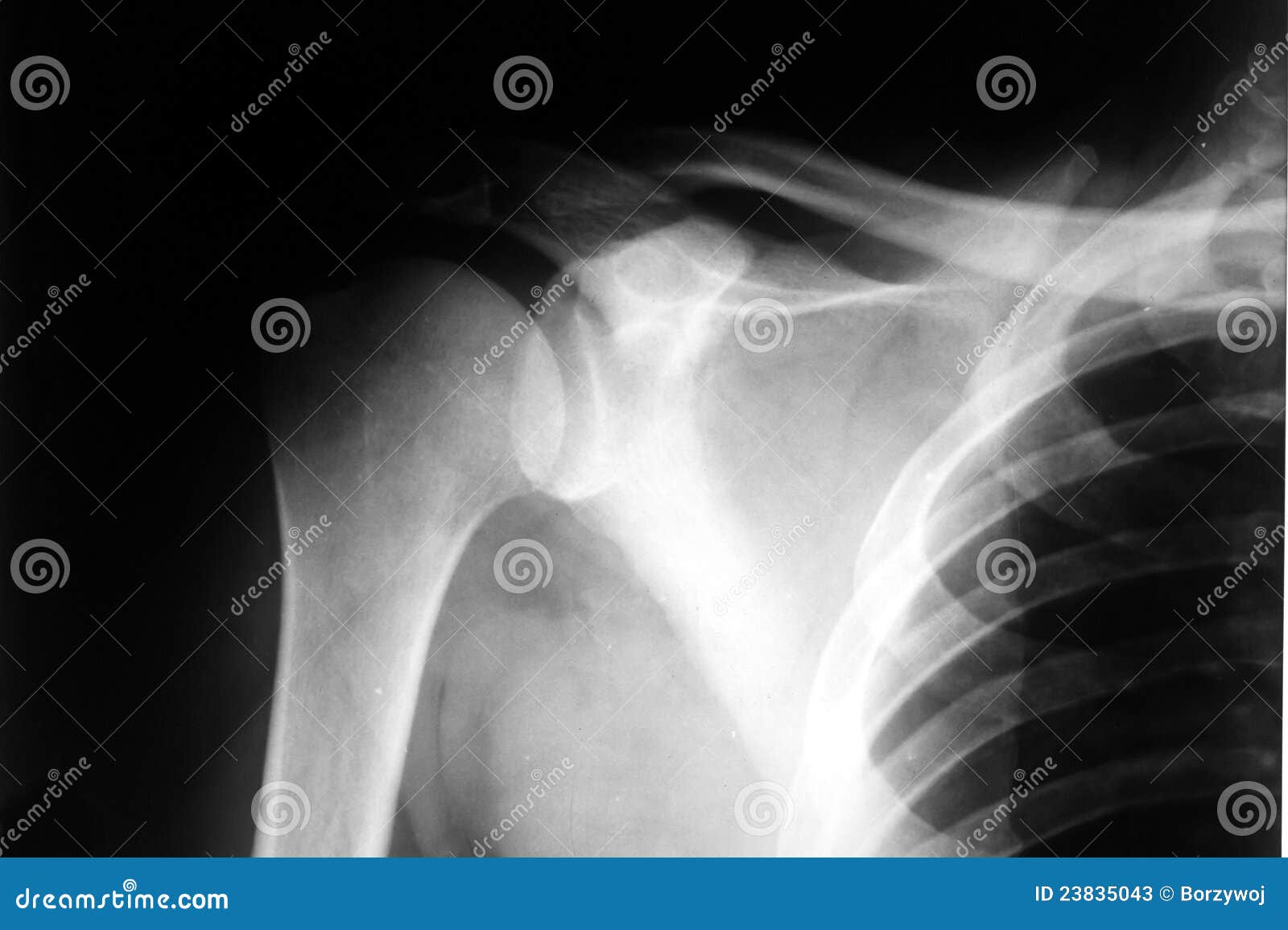 A Shoulder Xray Film Showing Fractured Second To To Fifth Ribs With ...