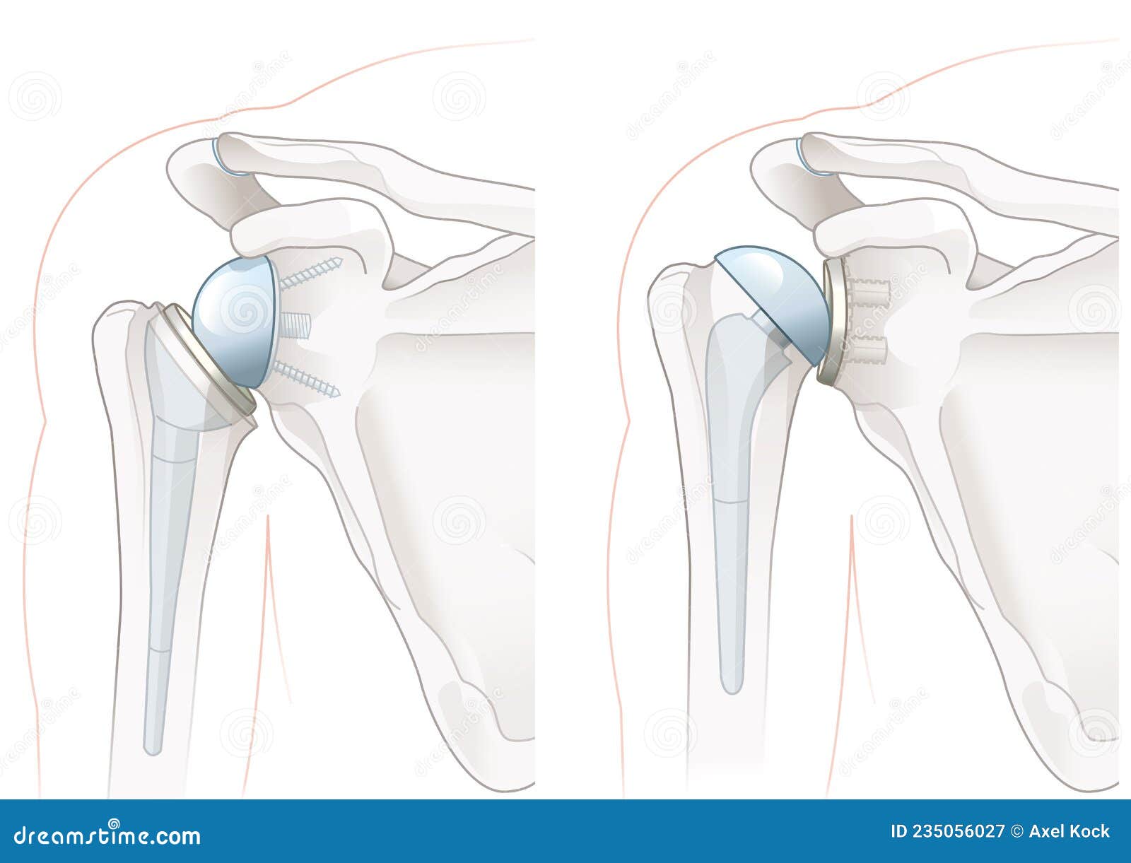 Shoulder Arthroplasty. Shoulder Replacement. Illustration Stock ...