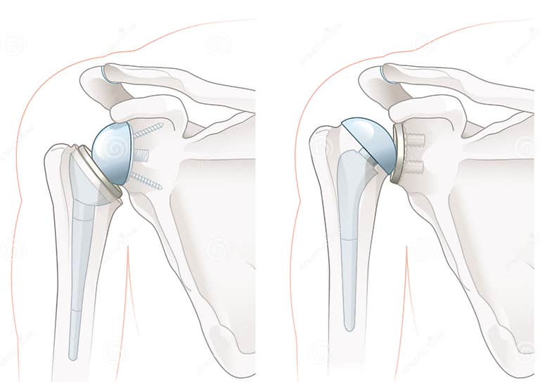 Shoulder Arthroplasty. Shoulder Replacement. Illustration Stock ...