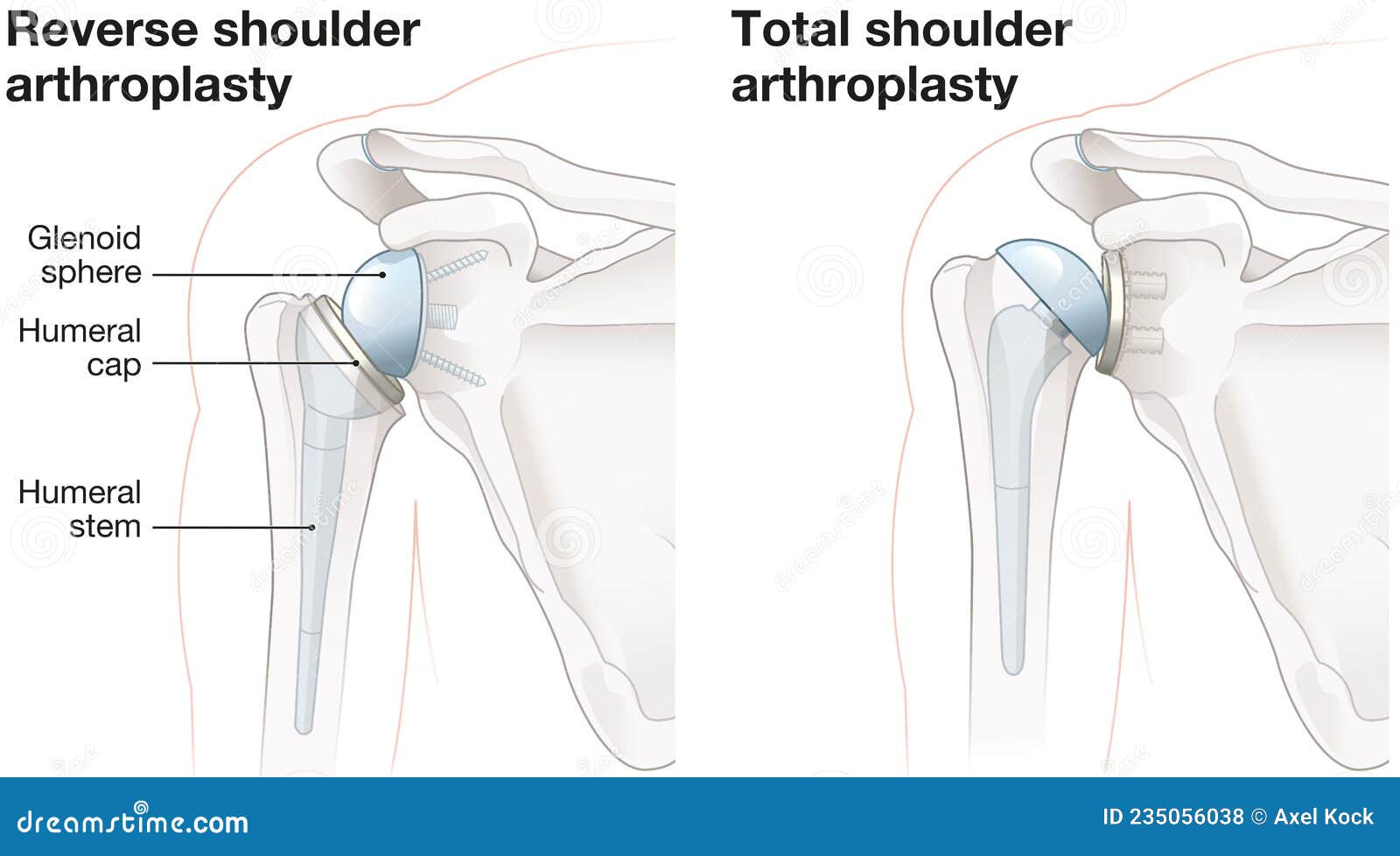 Shoulder Arthroplasty. Shoulder Replacement. Illustration Stock ...