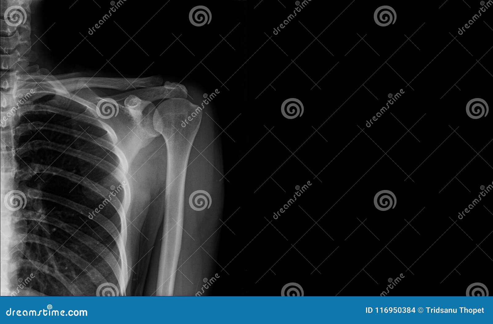 Shoulder X-ray Banner Royalty-Free Stock Photo | CartoonDealer.com ...