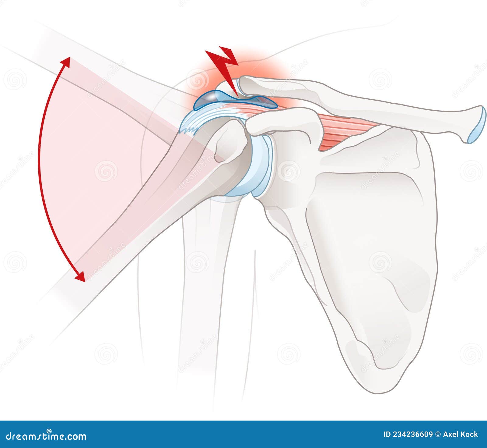Shoulder Impingement. Painful Arc. Labeled Illustration Stock Photo ...