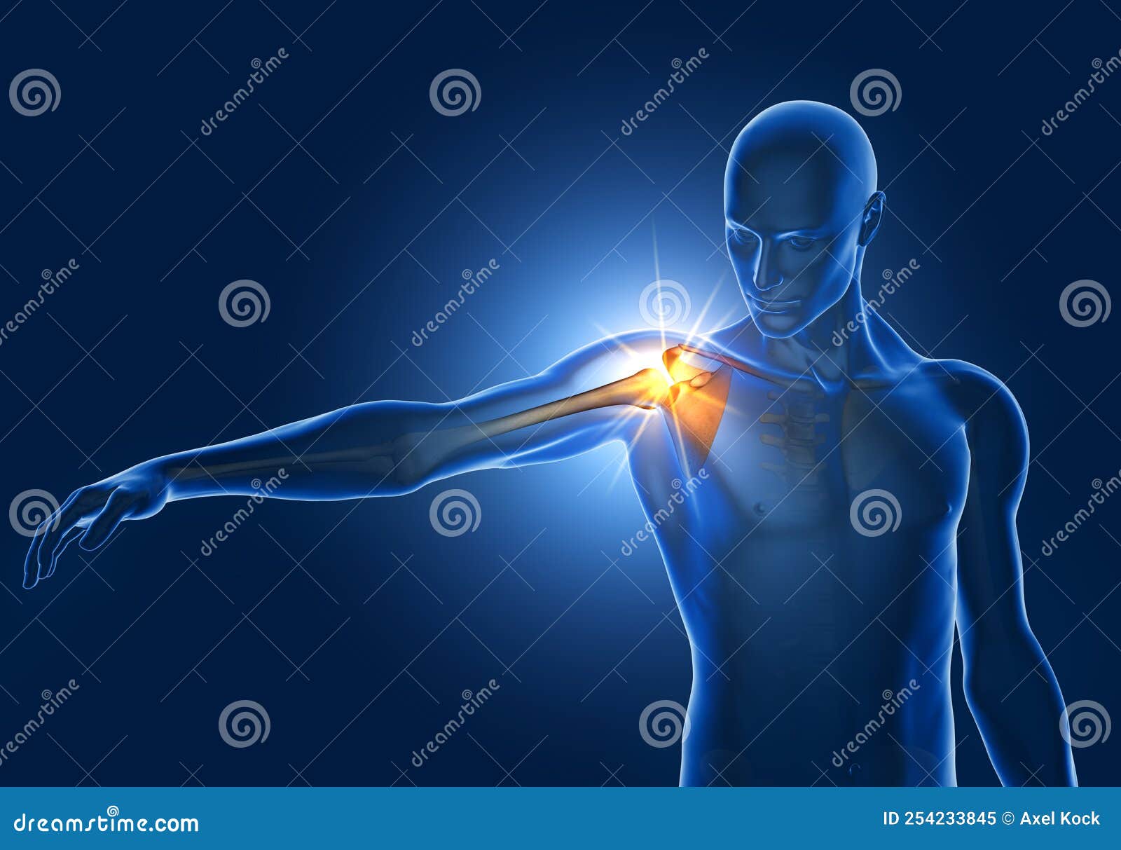 Shoulder Impingement Syndrome From Rubbing Rotator Cuff Outline Diagram ...