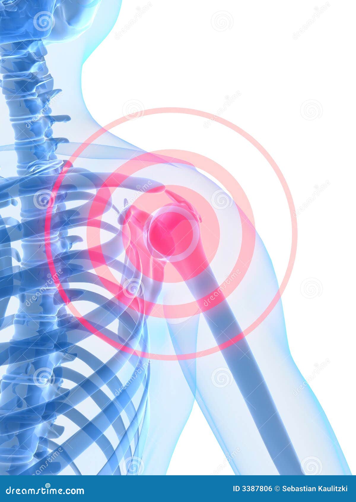 Shoulder inflammation stock illustration. Illustration of ribs - 3387806