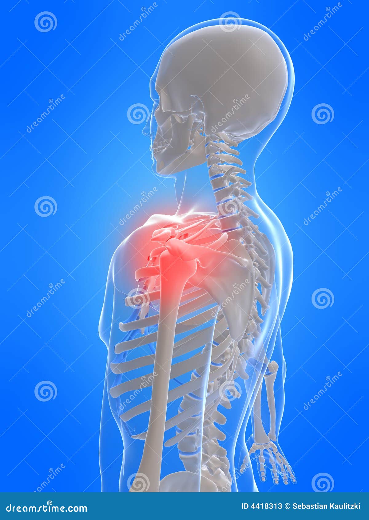 Shoulder inflammation stock illustration. Illustration of arthritis ...