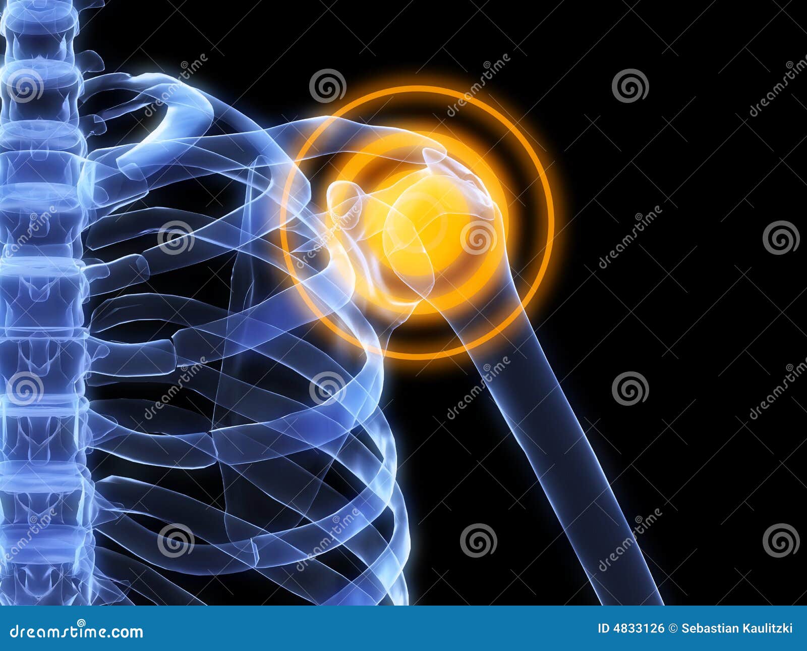 Shoulder inflammation stock illustration. Illustration of skeletal ...