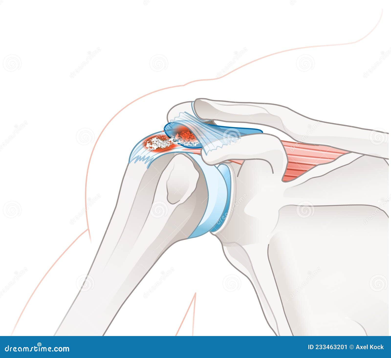Tendinitis Cartoons, Illustrations & Vector Stock Images - 552 Pictures ...