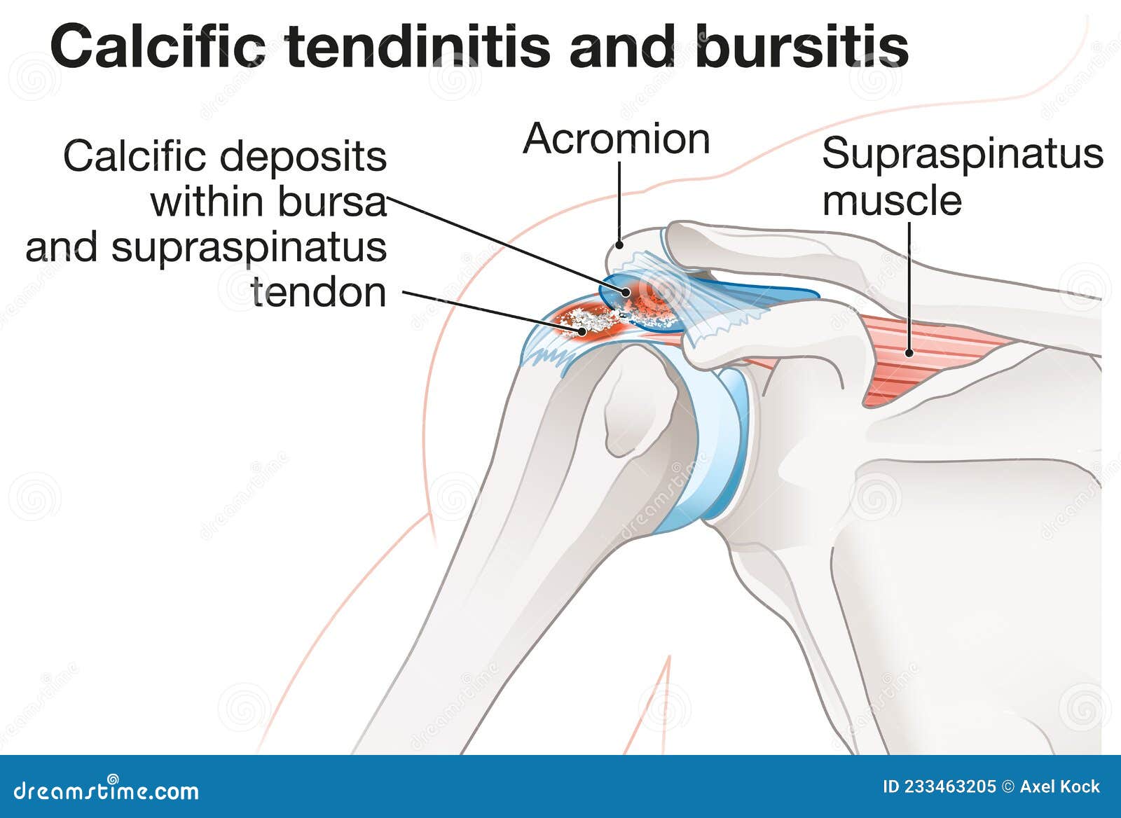 Calcific Tendinitis Shoulder Illustration. Labeled Stock Image ...