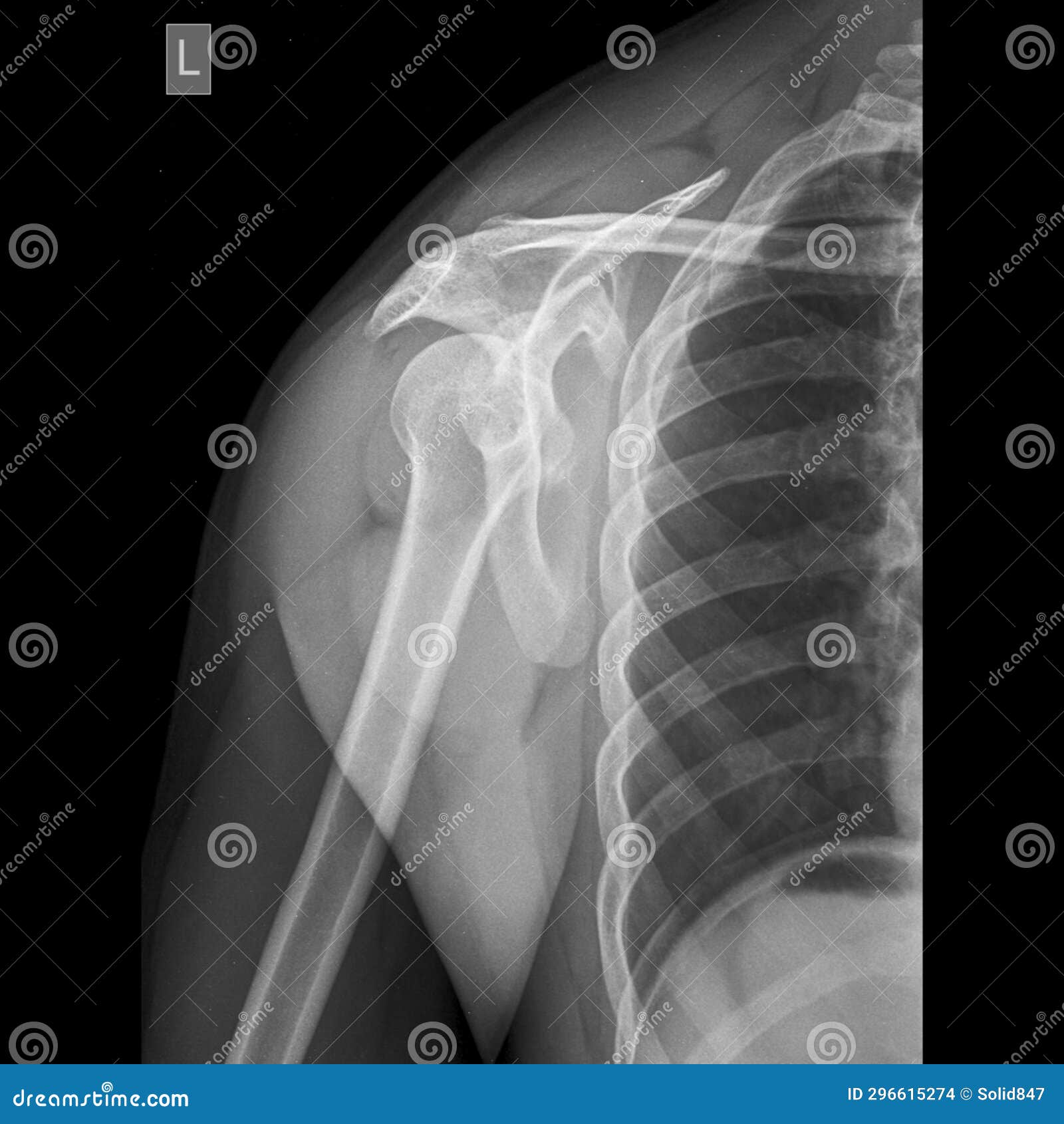 Shoulder Joint X-ray Image Lateral View Stock Photo - Image of imaging ...