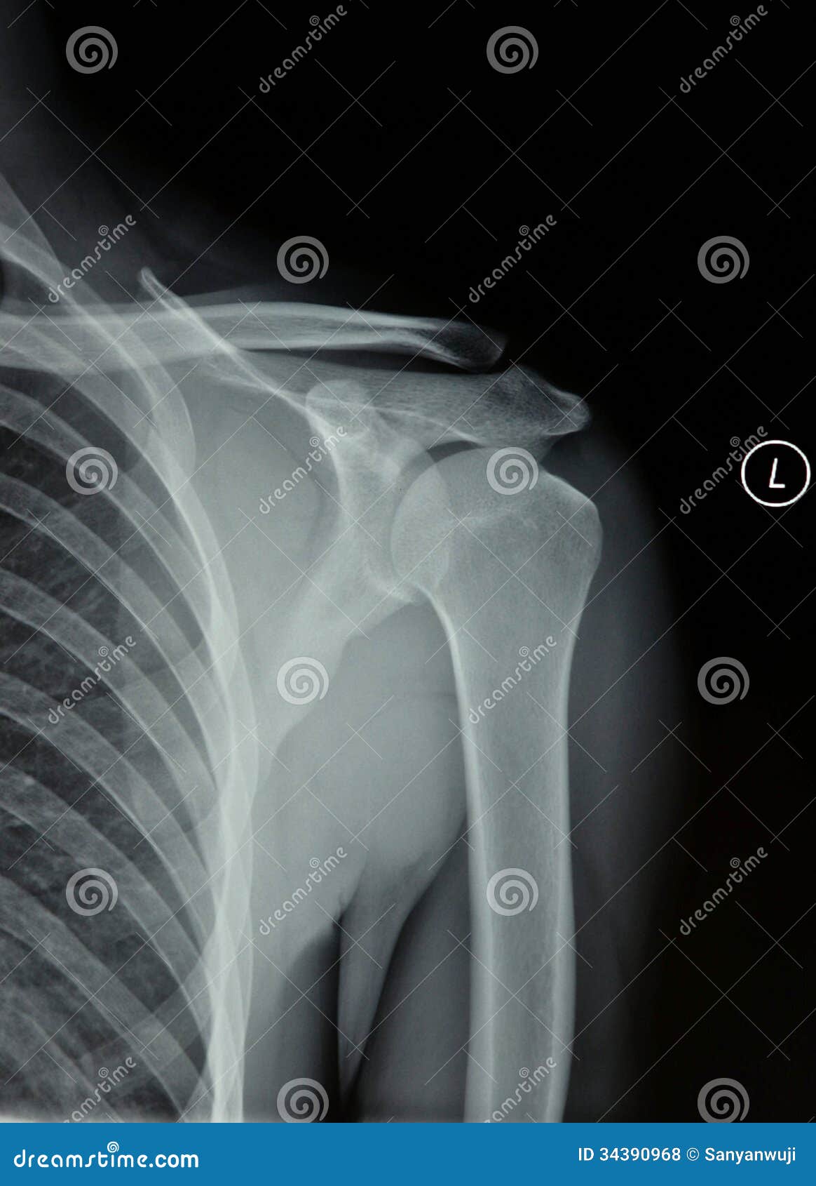 X Ray Shoulder Anatomy
