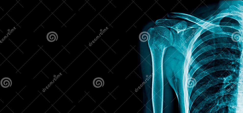 Shoulder x-ray banner stock image. Image of health, banner - 123022815