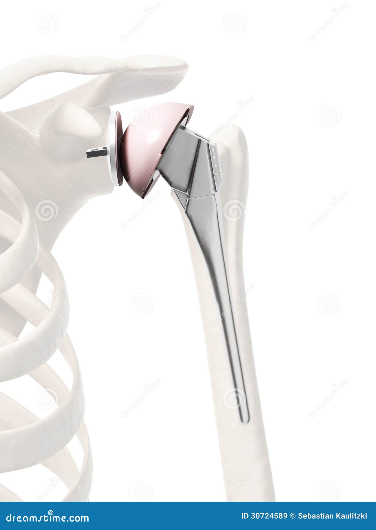 Shoulder Replacement Stock Illustration | CartoonDealer.com #30724591