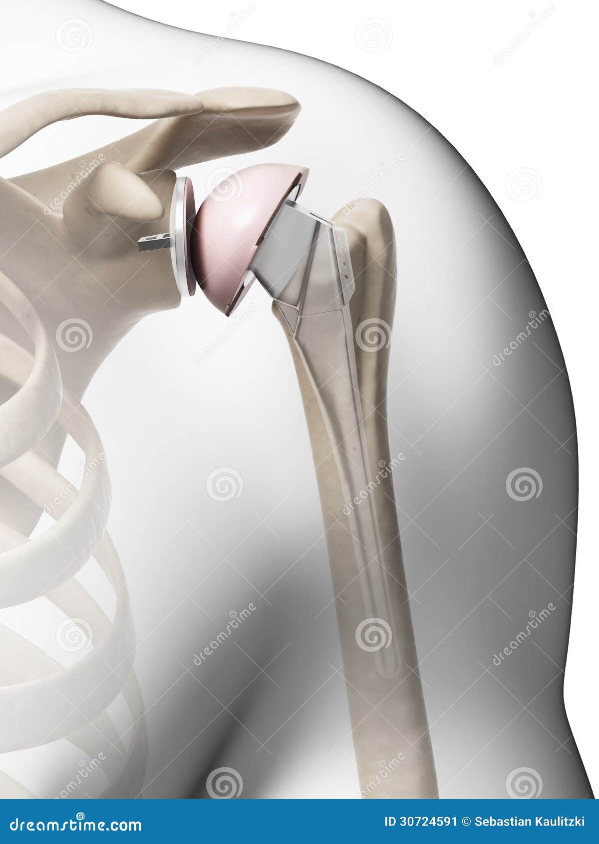 Shoulder Replacement Stock Illustration | CartoonDealer.com #30724591