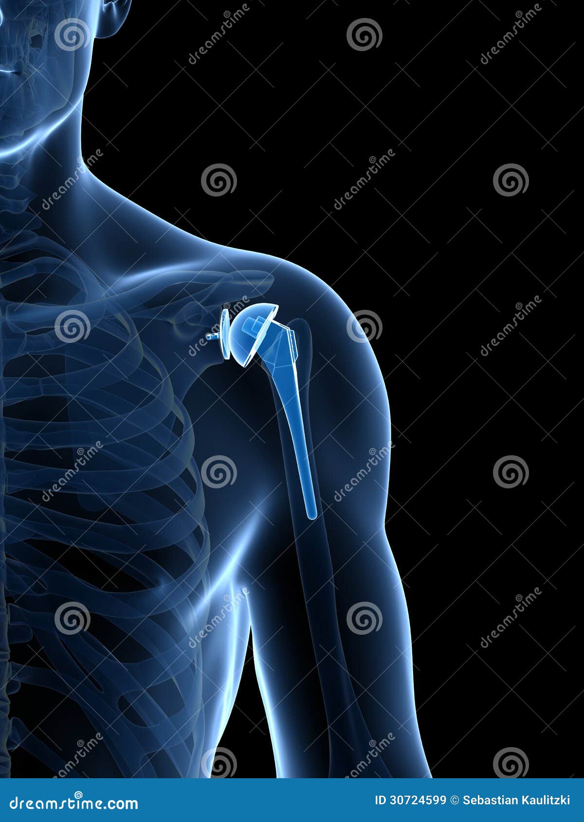 Shoulder replacement stock illustration. Illustration of skeletal ...