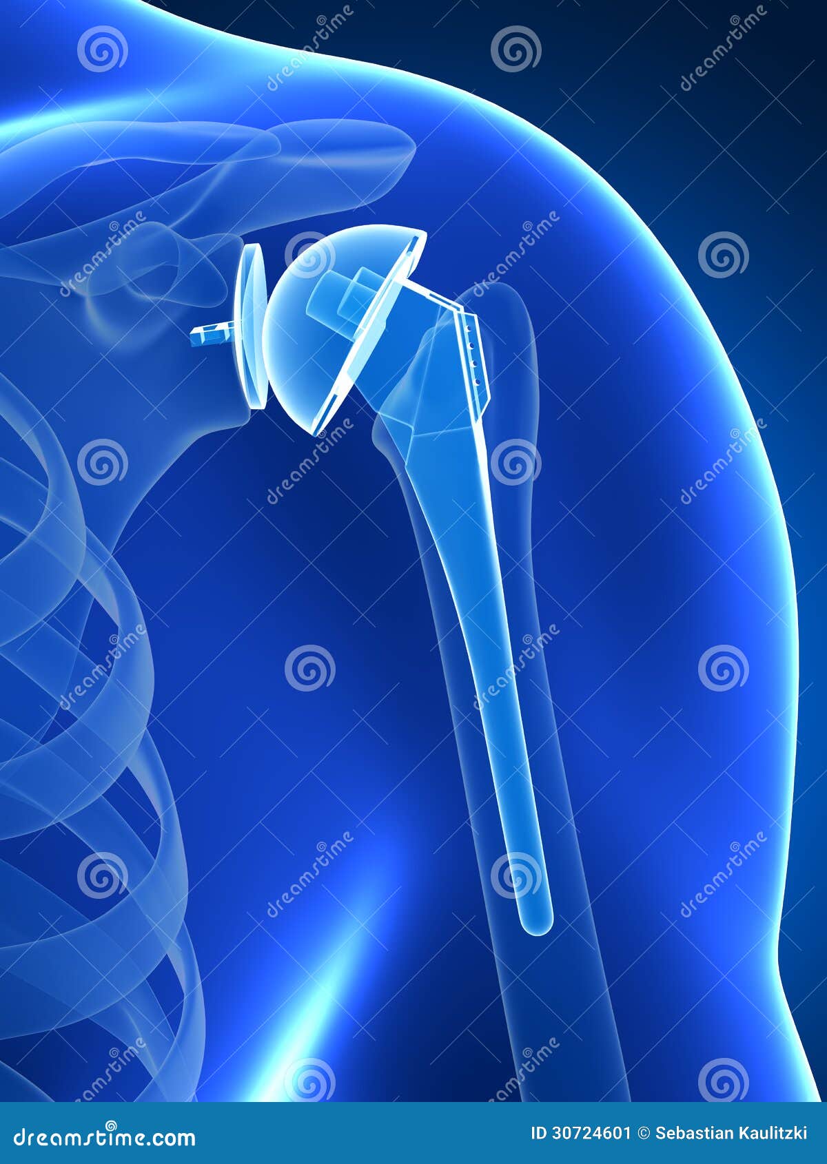 Shoulder replacement stock illustration. Illustration of artwork - 30724601