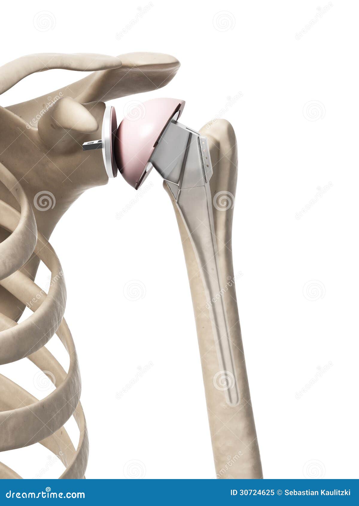 Shoulder replacement stock illustration. Illustration of artwork - 30724625