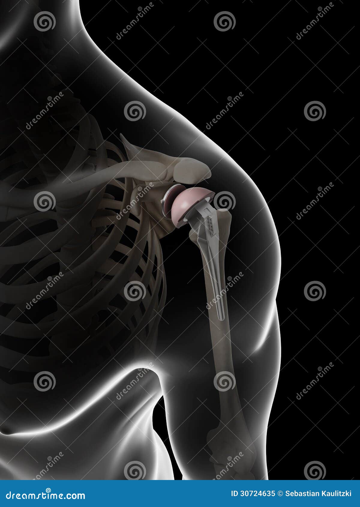 Shoulder replacement stock illustration. Illustration of humerus - 30724635