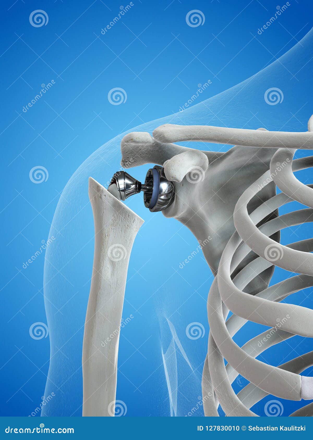 A shoulder replacement stock illustration. Illustration of bones ...