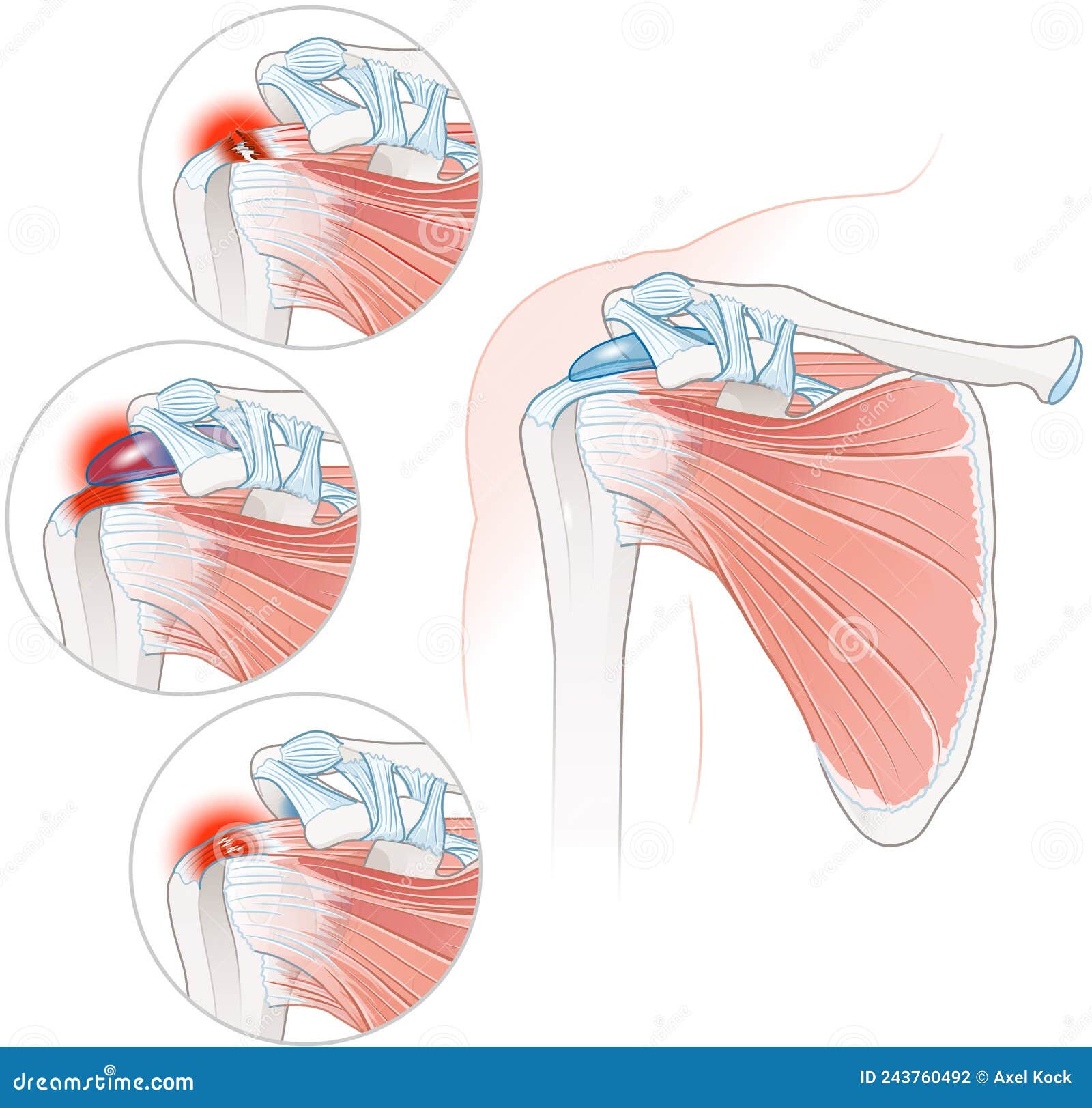 Shoulder Rotator Cuff Disease Illustration. Labeled Stock Illustration ...