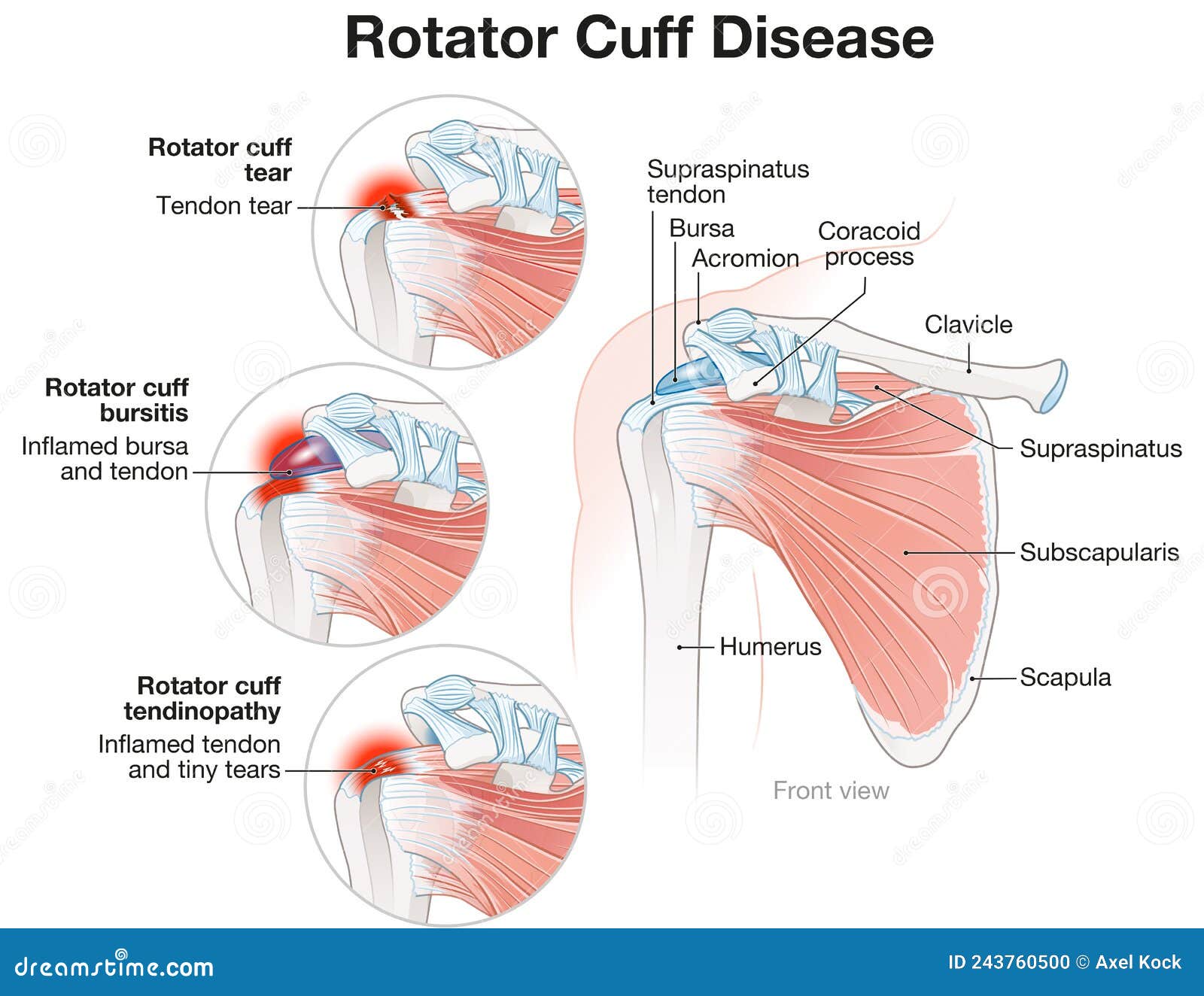 Rotator Cuff Tendinitis As Shoulder Muscular Inflammation Outline ...