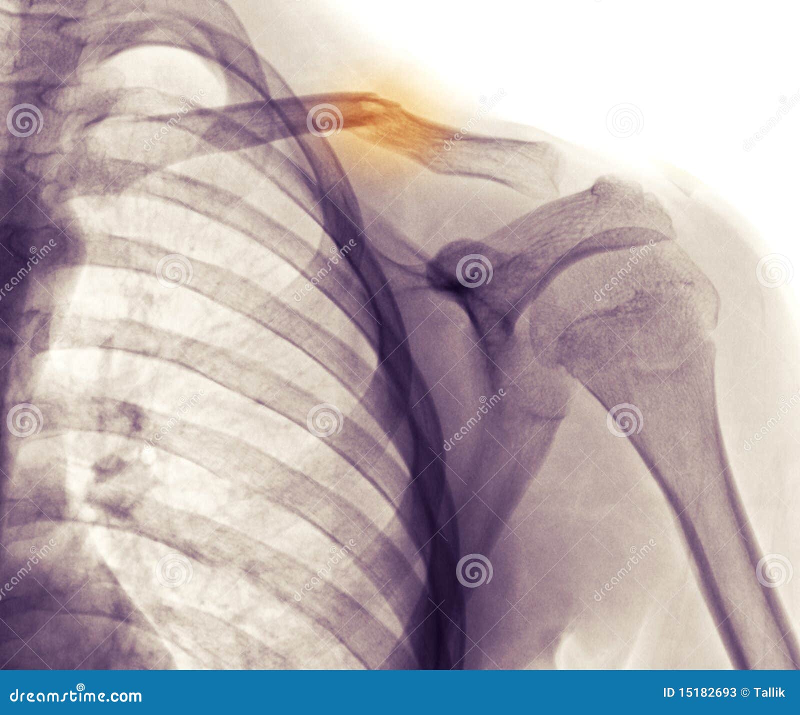 Shoulder X-ray, Clavicle (collarbone) Fracture Royalty-Free Stock ...