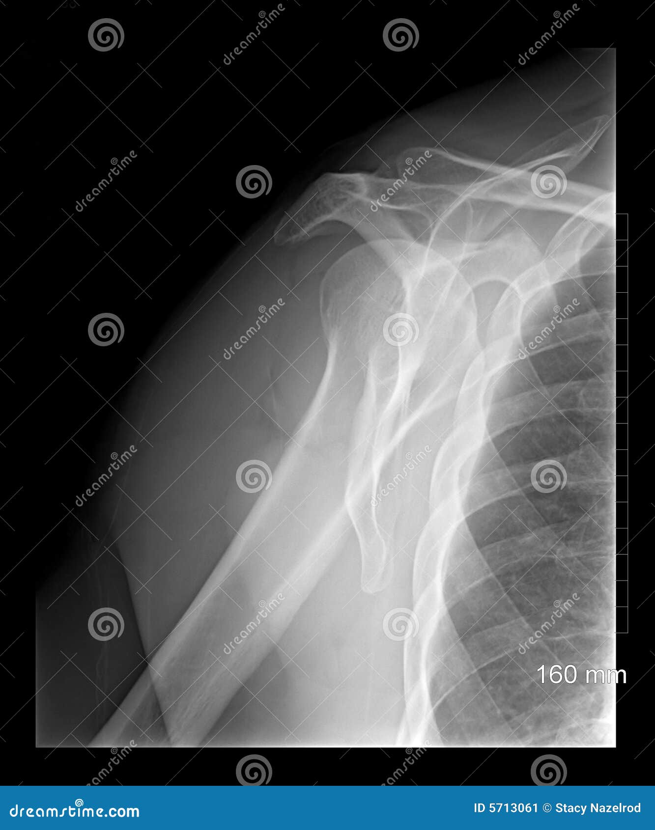 A Shoulder Xray Film Showing Fractured Second To To Fifth Ribs With ...