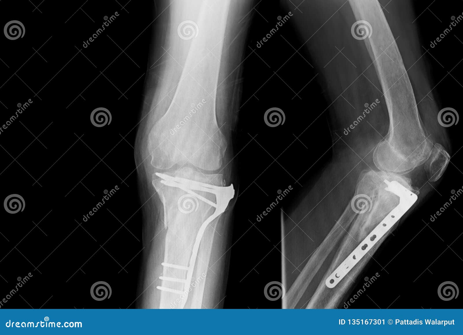 Compound Fracture X Ray