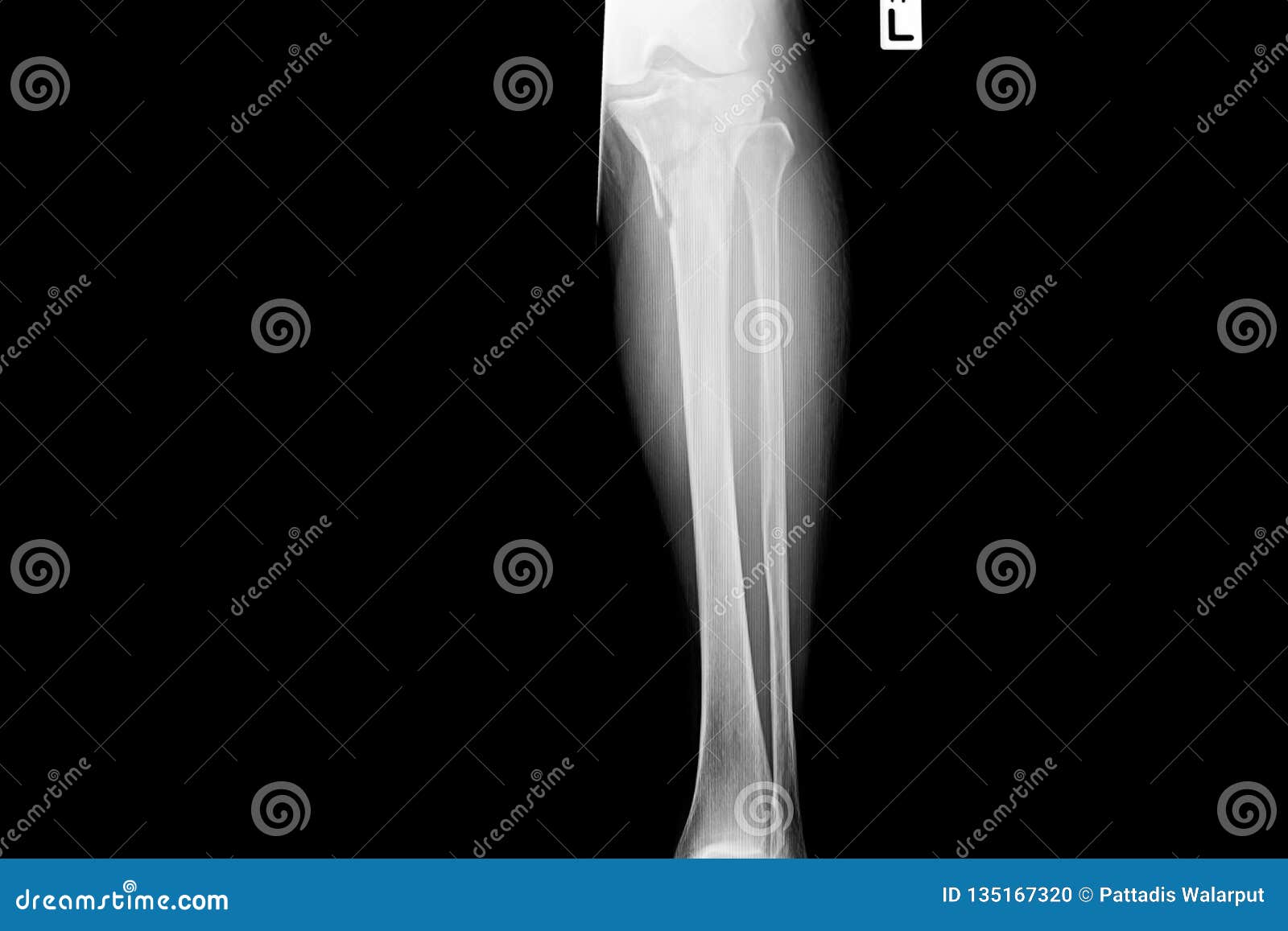 Show Image of Tibia and Fibula Left Lateral Stock Photo - Image of ...