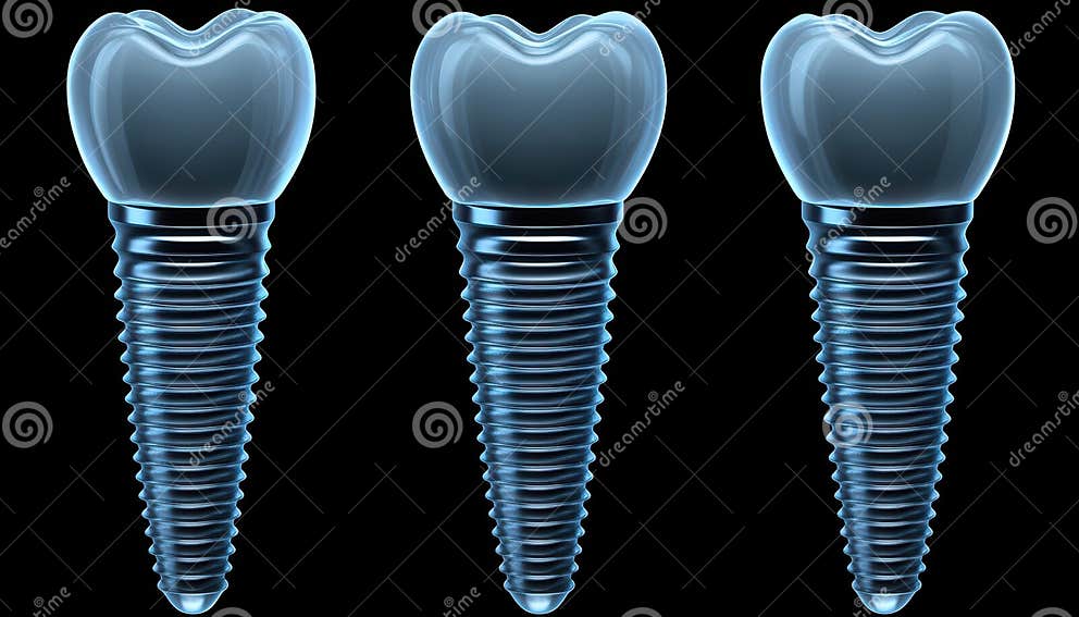 Showcasing Precision and Tech Advancements in Tooth Implants Stock ...