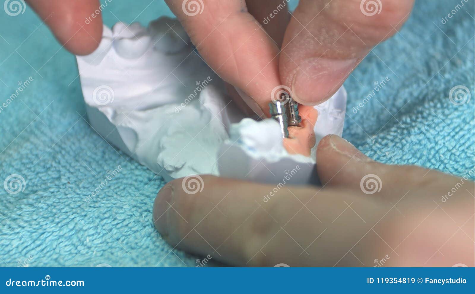 Showing the Installation Process of Dental Implants Stock Image - Image ...