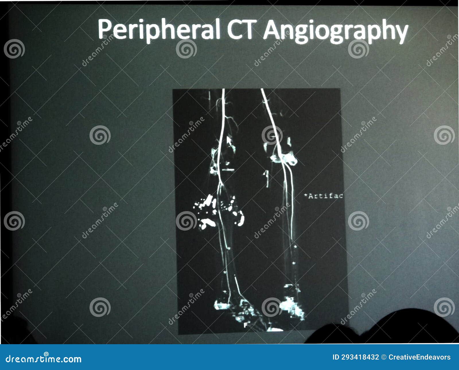 Shrapnel Arterial Injuries from Hamas Rocket Explosions Stock Photo ...