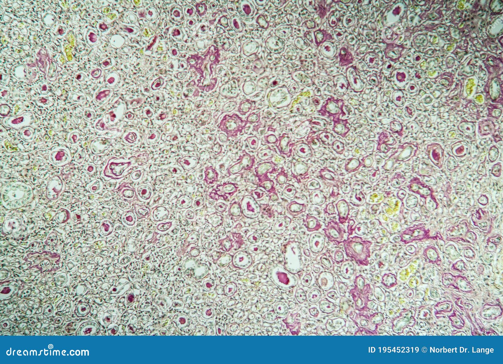 Shrinked Kidney Diseased Tissue Stock Image - Image of medicine, tissue ...