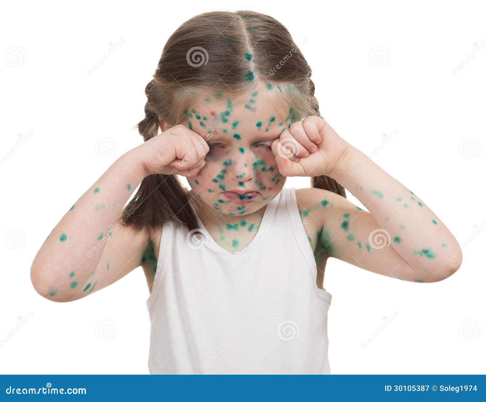 Sick child. chickenpox stock image. Image of girl, child - 30105387