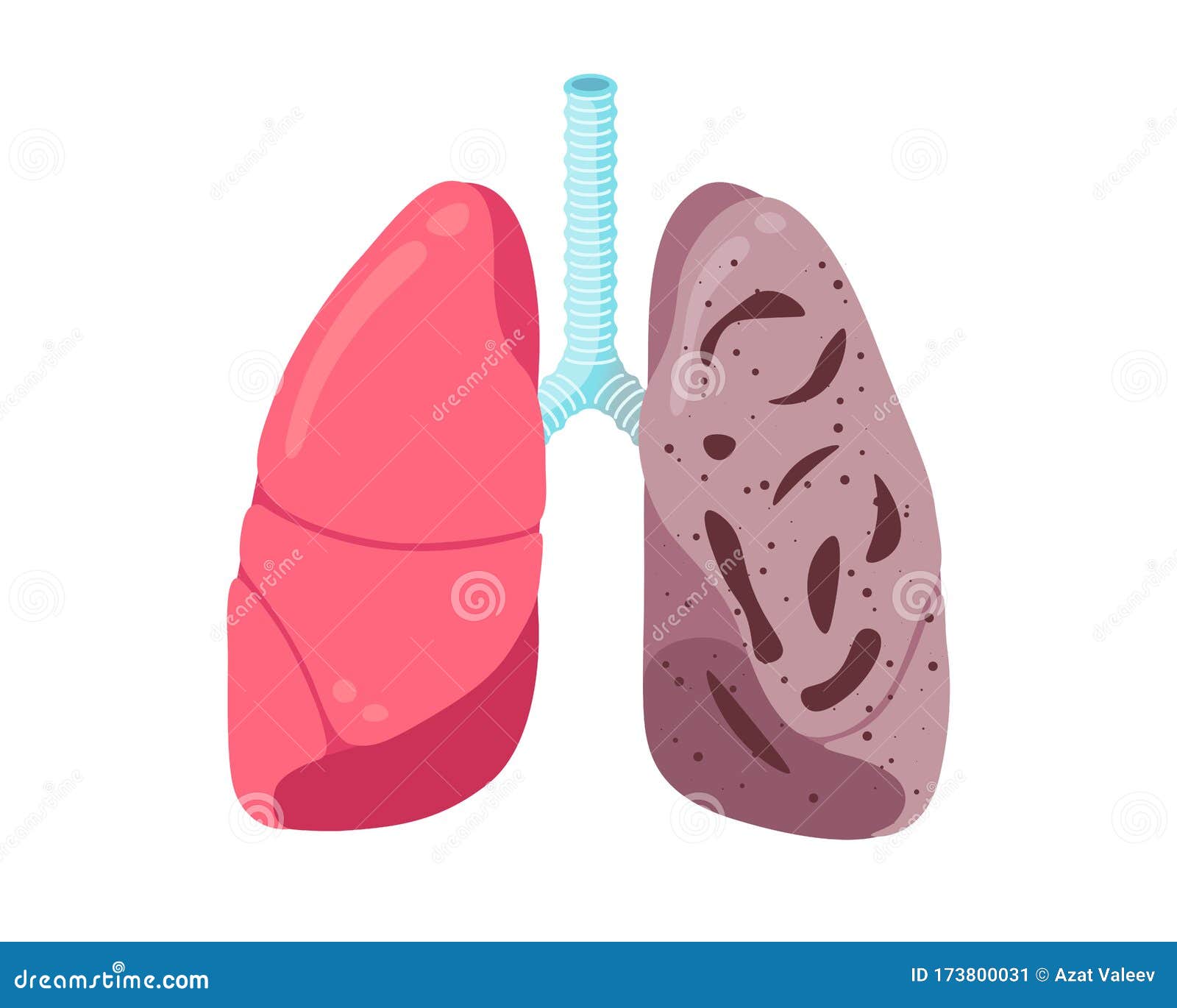 Sick Unhealthy Lungs Tuberculosis Infection Disease Human Respiratory