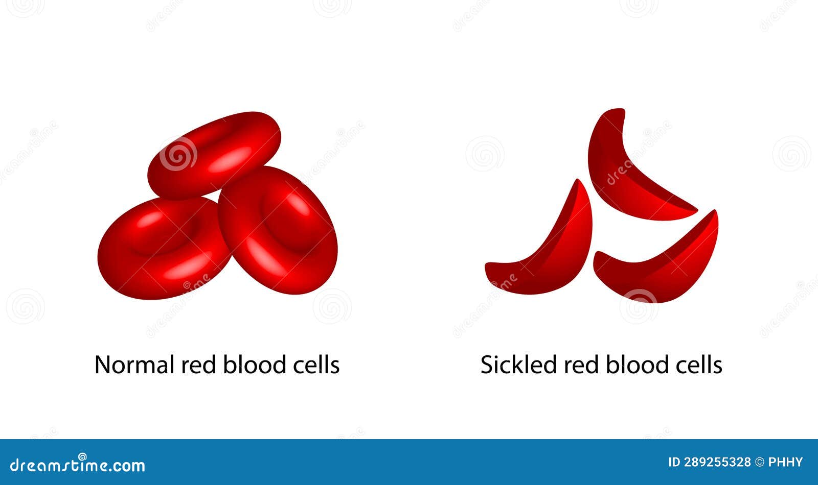 Sickle Cell Anemia, Disease. Normal and Sickled Red Blood Cells. Stock ...