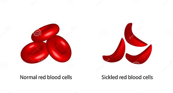 Sickle Cell Anemia, Disease. Normal and Sickled Red Blood Cells. Stock ...
