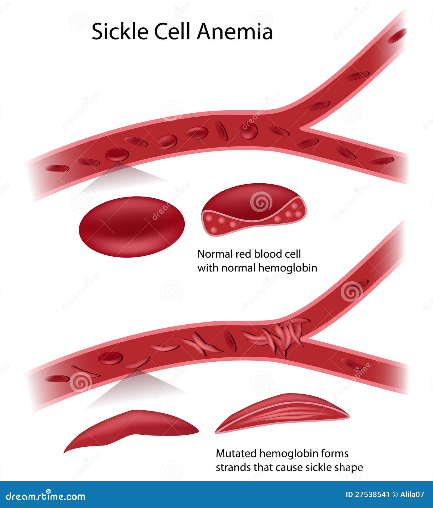 Sickle cell disease stock vector. Illustration of blocked - 27538541