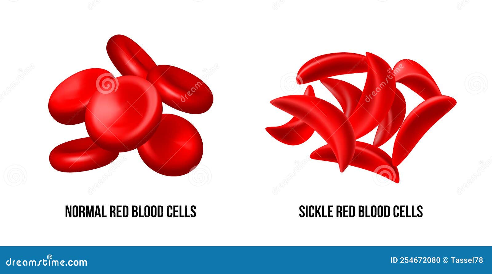 Sickle Cell Disease. the Difference of Normal Red Blood Cell and Sickle ...