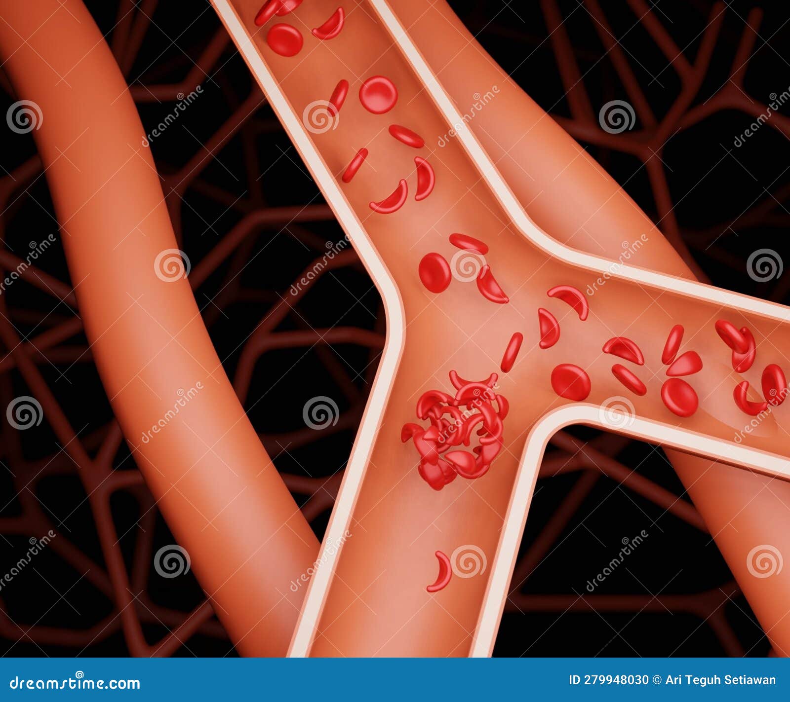 Sickling of Red Blood Cells Can Increase the Risk of Developing Blood ...