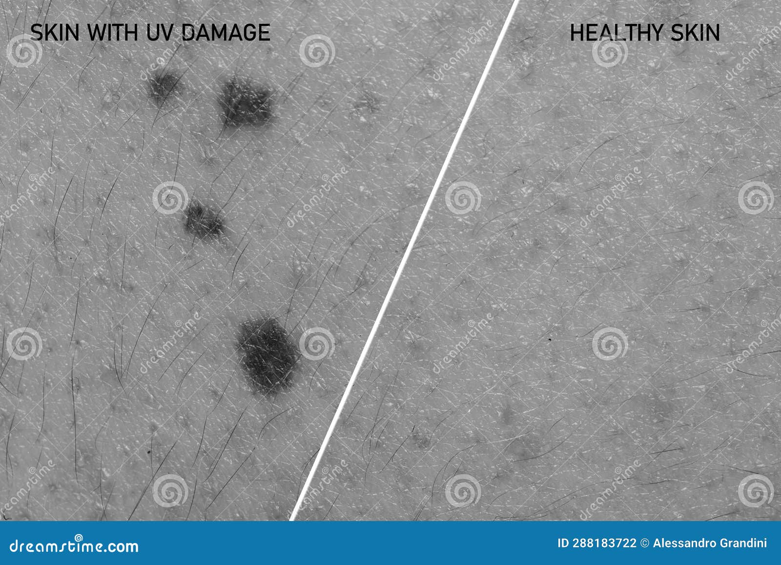 A Side by Side Comparison of Human Skin with and without UV Damage ...