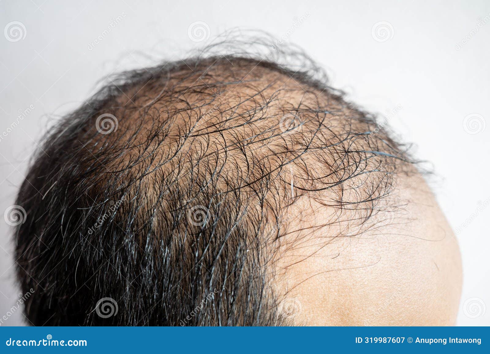 Side View of Baldness Men S Head with Thin Hair on His Top and Forehead ...