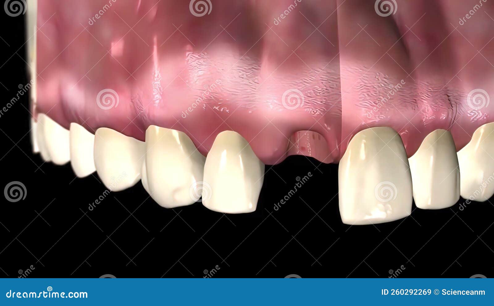 Side View of the Extracted Tooth Stock Illustration - Illustration of ...