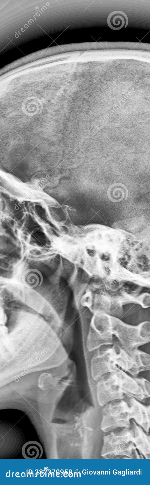 Side View of Human Brain X-ray Medical Scan Stock Photo - Image of blue ...