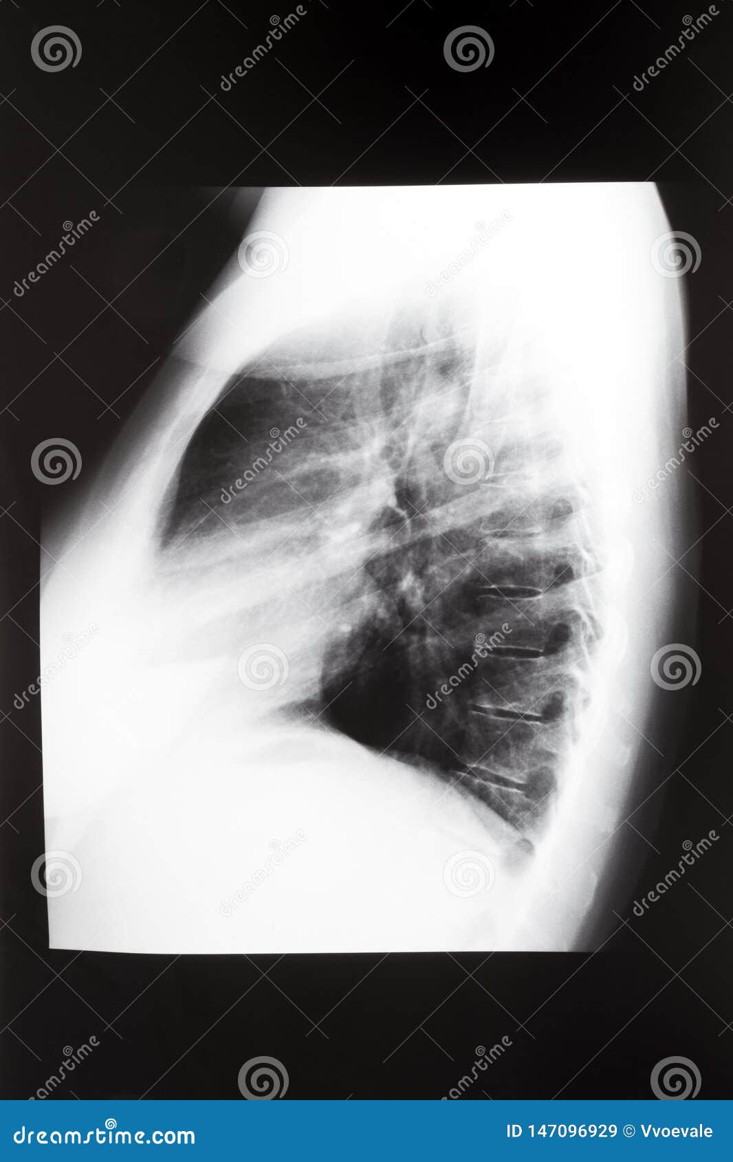 Side View of Human Thorax with Lungs Stock Image - Image of white ...
