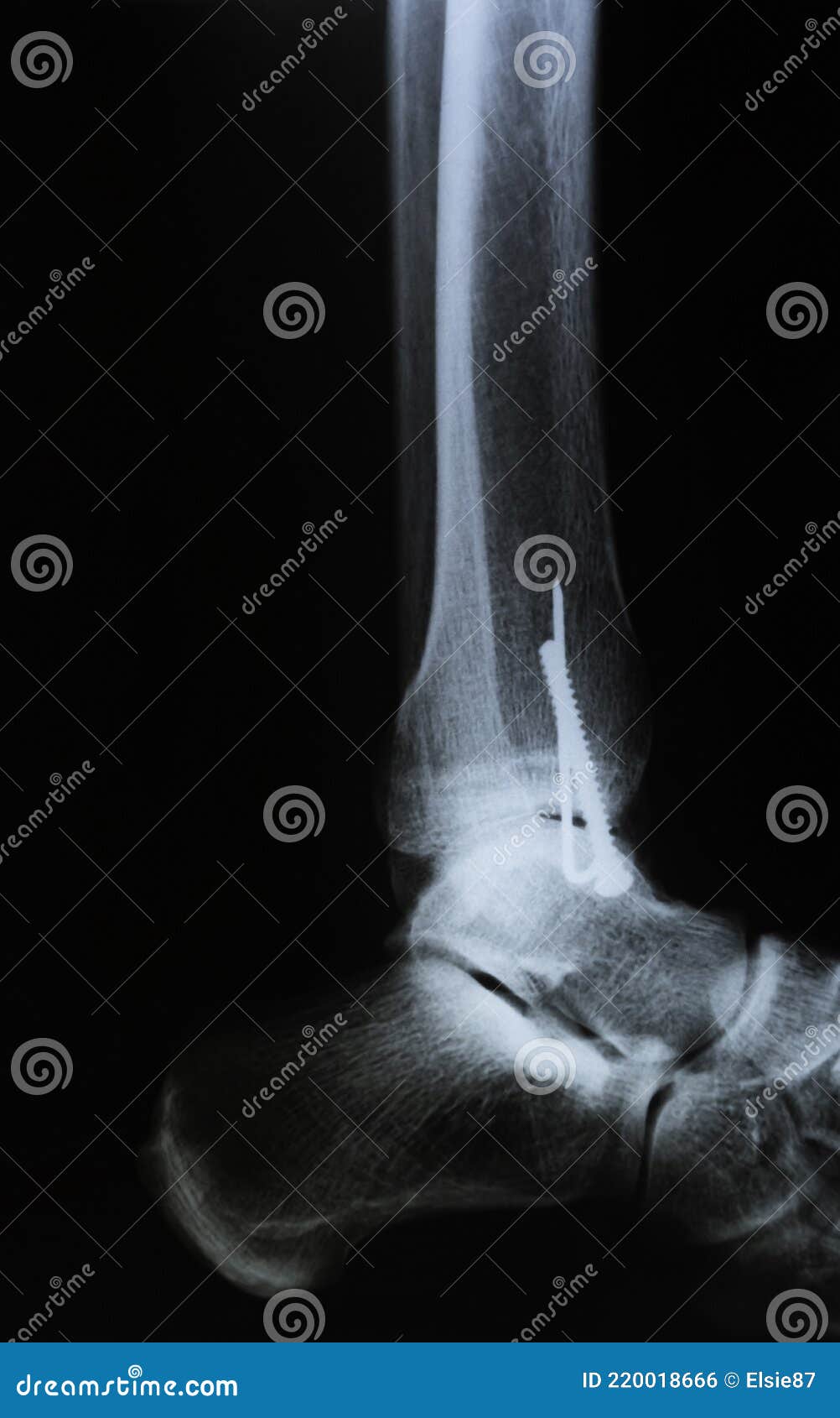 Side View of X-RAY Scan. Human Leg with Metal after the Surgery. Stock ...