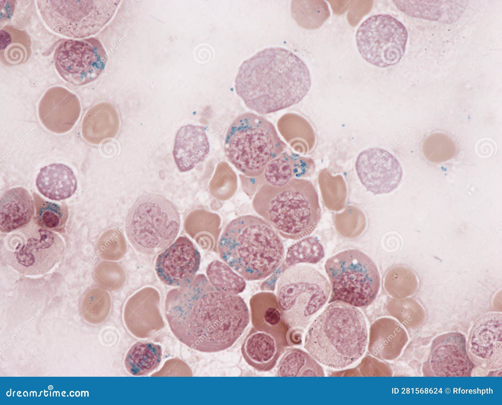 Sideroblastic anemia. stock photo. Image of anemia, myelodisplastic ...